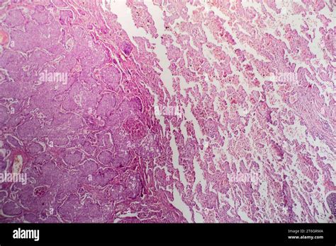 Photomicrograph Of Lung Adenocarcinoma Illustrating Malignant