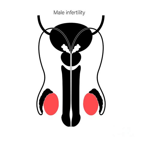 Male Infertility By Pikovit Science Photo Library