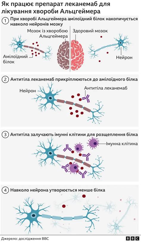 Препарат леканемаб став проривом у лікуванні хвороби Альцгеймера Bbc News Україна