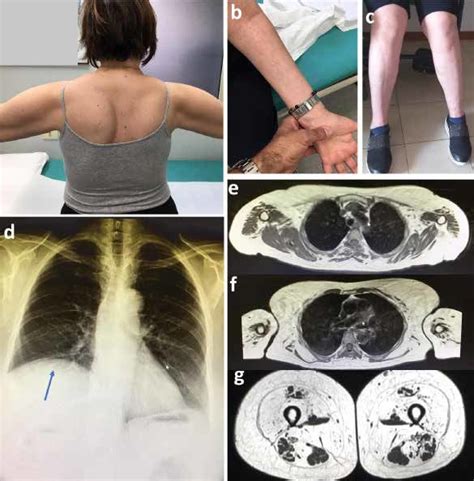 A Asymmetric Scapular Winging B Distal Arm Atrophy C Asymmetric Download Scientific