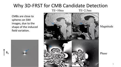 Cerebral Microbleed Detection Using Susceptibility Weighted Imaging And Deep Learning Ppt