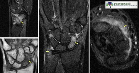 🩻 Part 2 Suspect Scaphoid Fracture And Non Displaced Ulnar Styloid Process Fracture Required