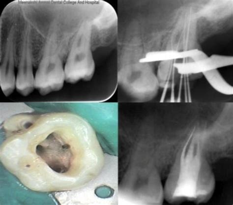 Endodontic Management Of Maxillary Second Molars Fused With Paramolar Tubercles Diagnosed By