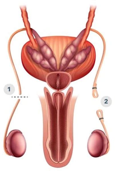 Vastectomy Hong Kong Urology Clinic 香港泌尿專科治療中心