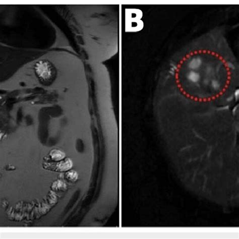 Mri Of The Abdomen And Pelvis Mri Of The Abdomen And Pelvis A