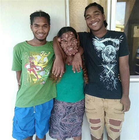 Incredible Joy For Mom Of Two With One Of A Kind Disease That Caused