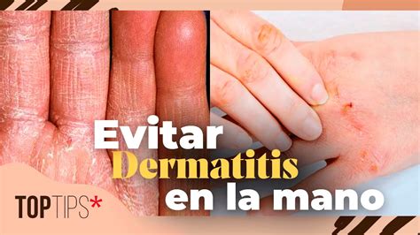 Dermatitis De Las Manos Fotos Dermatitis Tjha