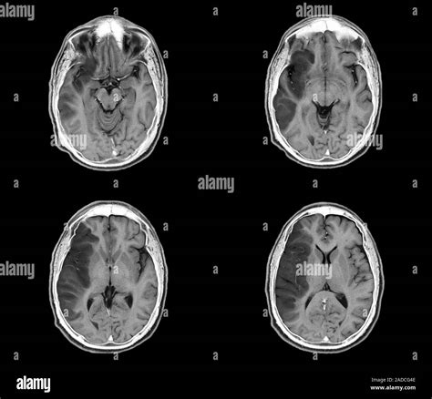 Stroke Axial Magnetic Resonance Imaging Mri Scans Through The Brain