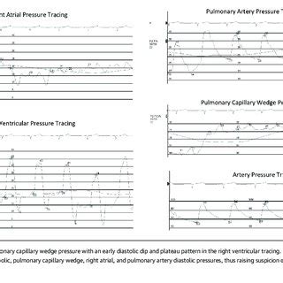 Right Sided Heart Catheterization Tracings Download Scientific Diagram