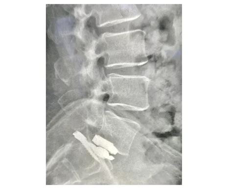 Dr Todd Lanman Begins Breakthrough Low Back Total Joint Replacement