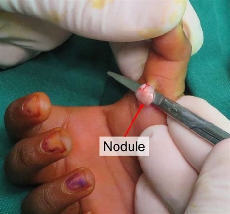 Congenital Trigger Thumb