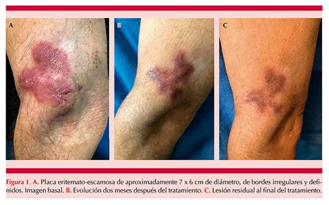 Cromoblastomicosis Atípica En Placa Superficial Y Crónica Causada Por