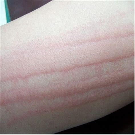 胆碱能性荨麻疹病症图片有来医生