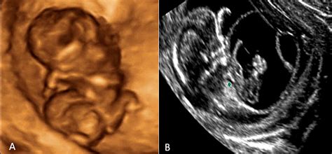 Ultrasound Imaging Of Early Embryonic And Fetal Development Article
