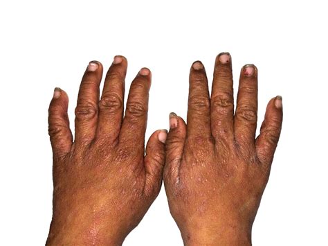 Scabies On Hands