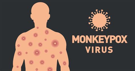 Monkeypox Symptoms What To Look For And How It Spreads