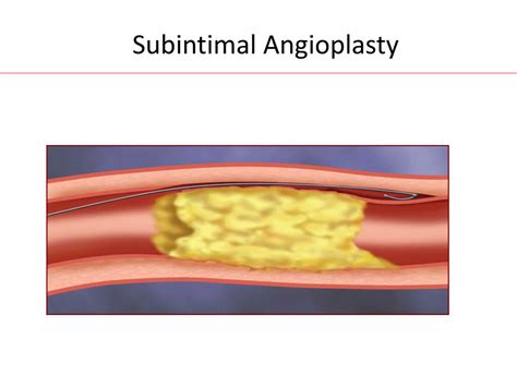 Ppt Evolving Strategies In The Treatment Of Peripheral Vascular