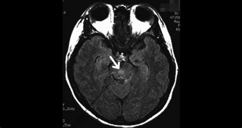 Bickerstaffs Encephalitis Hku E Learning Platform In Clinical
