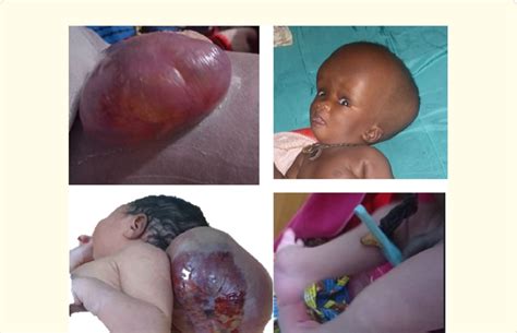 Various Forms Of Congenital Cns And Associated Abnormalities Congenital