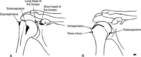 Hydroxyapatite Deposition Disease Musculoskeletal Key