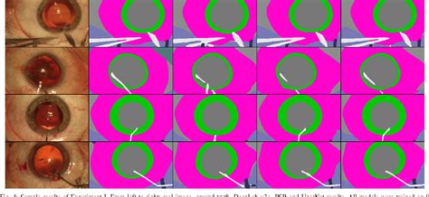 Cadis Cataract Dataset For Image Segmentation