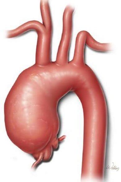Ascending Thoracic Aortic Aneurysm Pocket Size Mobile