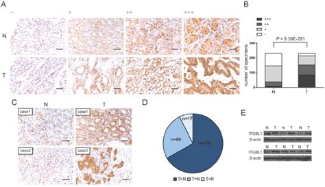 increased itgbl1 expression at protein level in gastric cancer tissues