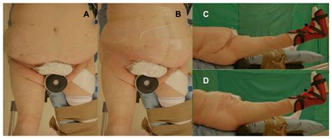 Which Is Better Anterior Or Posterior Hip Replacement Surgery