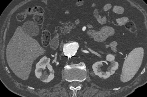 Unexpected Fevar In Evar Paris Vascular Insights
