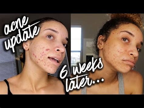 Acne Update 2 Im Starting Accutane Paleo Diet 6 Week Results