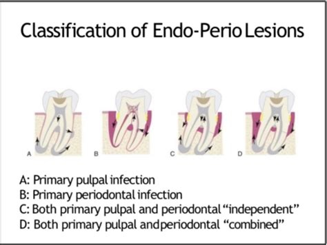 Endo Perio Lesions Flashcards Quizlet