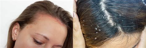 Mild Plaque Psoriasis On Scalp
