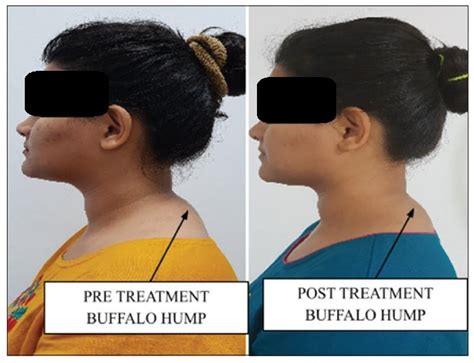 Buffalo Hump Before And After