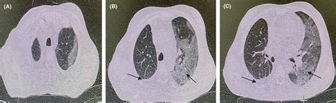 Hrct Chest Imaging After Four Days Of Treatment Relative Reduction Of