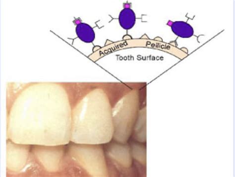 Cariology I Pit And Fissure Caries Flashcards Quizlet