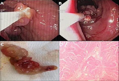 Pedunculated Polyps In Duodenum Were Removed By Using Traditional Snare Download Scientific