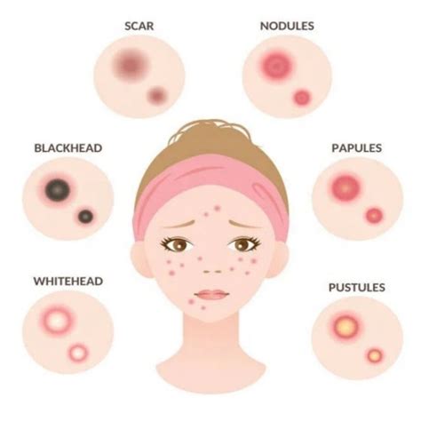 Factory Custom Oem Odm Ingredients Shape Hydrocolloid Acne Pimple Patch