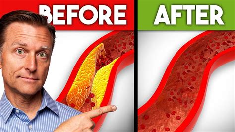 Best Nutrients To Remove Plaque From Arteries Plaque Build Up In