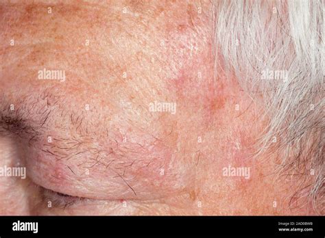 Shingles Close Up Of Blisters On The Forehead Of A 67 Year Old Male Patient With Shingles