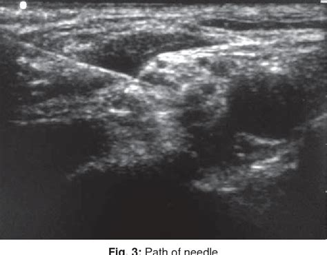 Figure 1 From Ultrasound Guided Supraclavicular Nerve Block In Plane