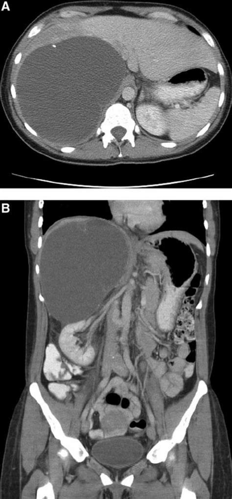 A Computed Tomography Ct Scan Demonstrating A Cystic Mass In The