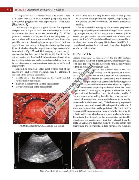 Ppt Laparoscopic Management Of Ectopic Pregnancy Powerpoint