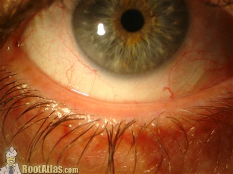 Glaucoma Eye Drops Side Effects
