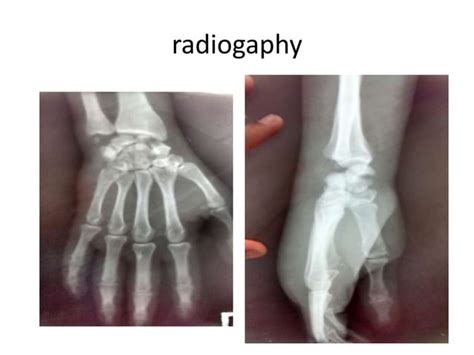 Perilunate Dislocation Carpal Injuries Ppt Free Download