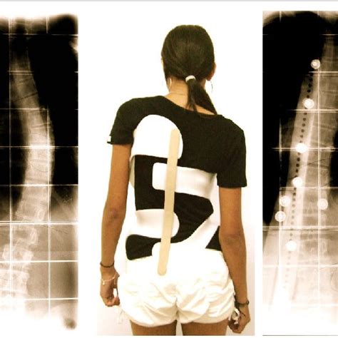 The Augmented Classification According To Lehnert Schroth Curvatures Download Scientific