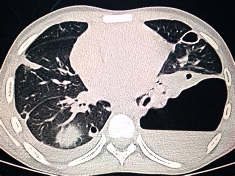 Septic Emboli Complicated By Hydropneumothorax Pul Case Complicated