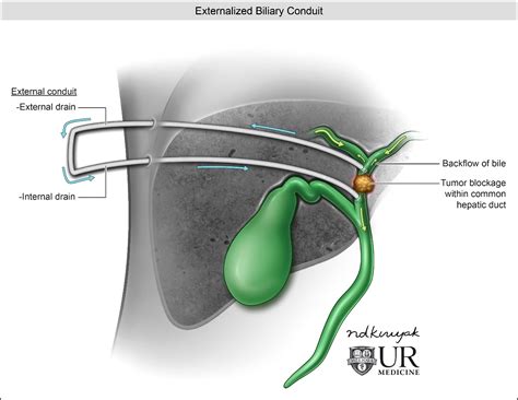 Biliary Drainage System