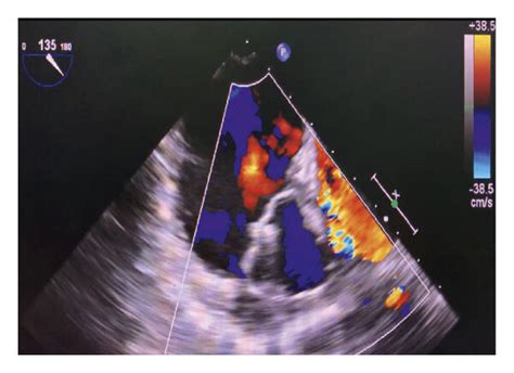Left Atrial Appendage Closure After Catheter Ablation With Watchman Download Scientific Diagram