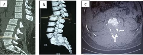 Dichotomous Profile Of Thoraco Lumbar Dislocation Fractures Case