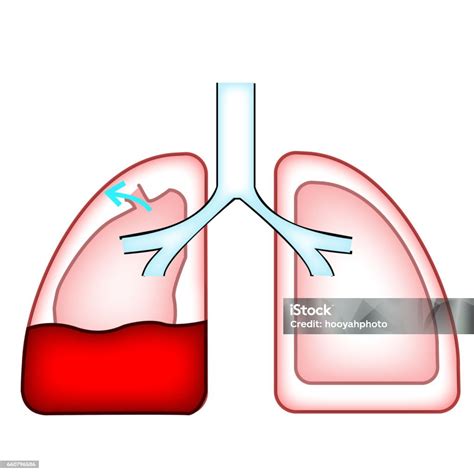 Hemothorax